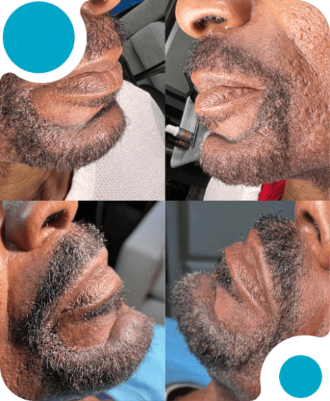 Facial Micropigmentation in Kansas City | Scalp Headquarters